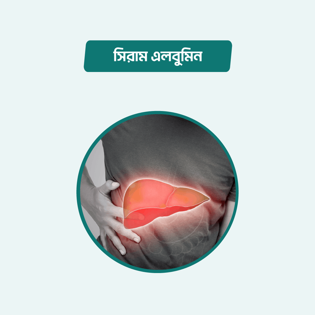 Serum-ascites albumin gradient(SAAG) - Arogga Online Lab